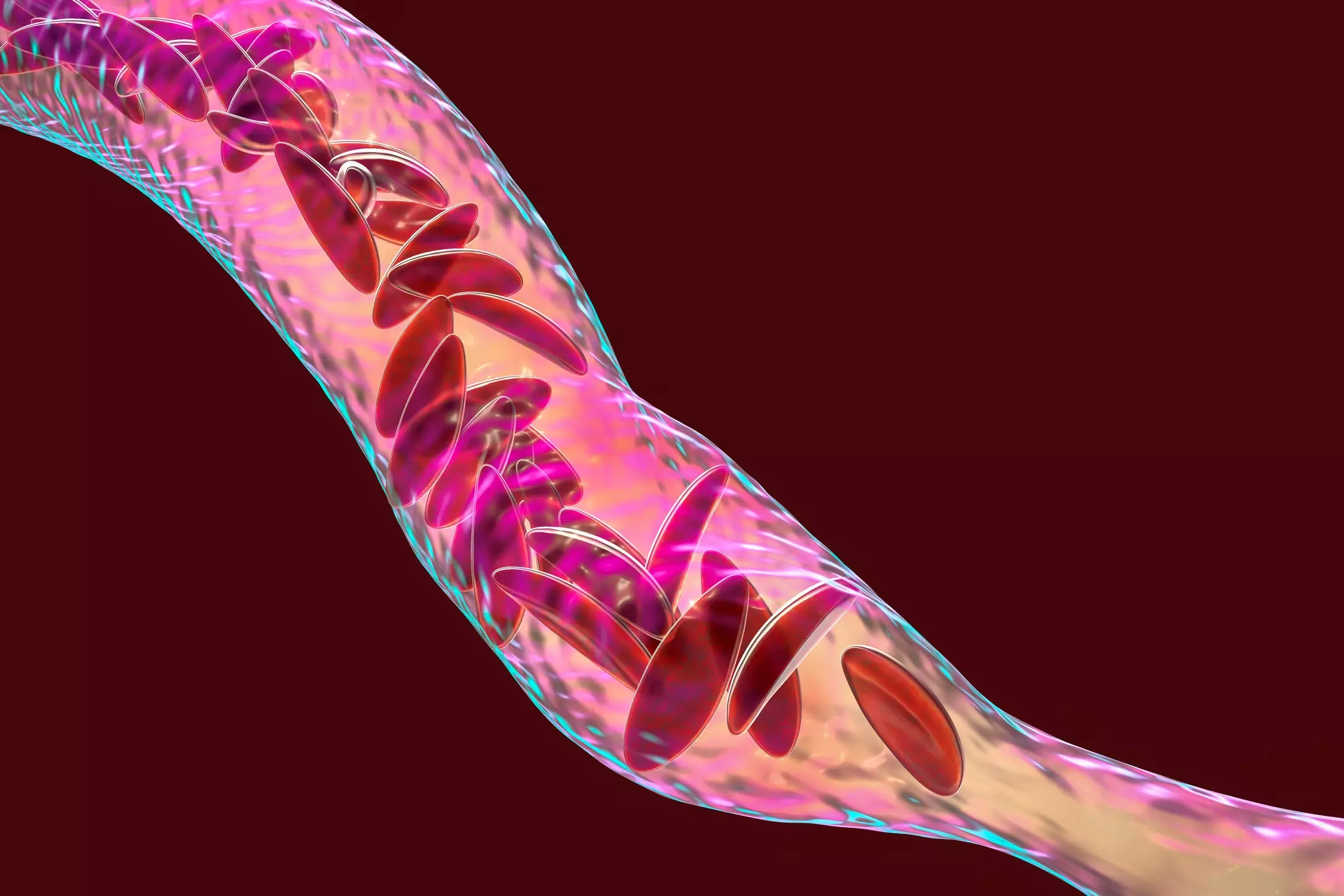 সিকেল সেল ডিজিজ, আমার অদৃশ্য অক্ষমতার জন্য একটি খোলা প্রেমের চিঠি